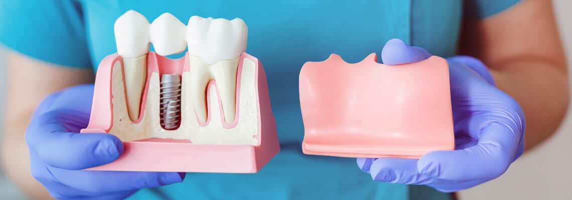 How To Replace Missing Teeth – Different Treatment Options