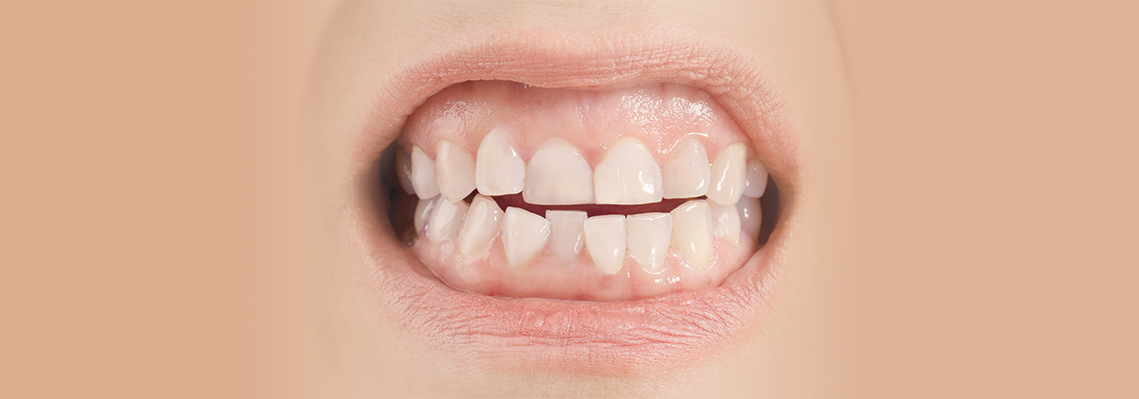 How to Fix Crowded Teeth: Best Treatment Options