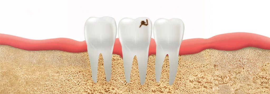 Signs and Symptoms of a Tooth Cavity: A Complete Guide